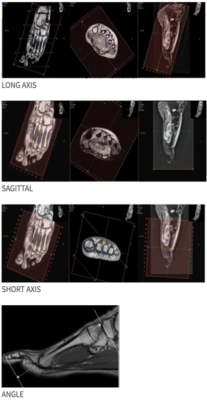 MR Foot - Entire Foot WO or W/WO MSK Protocol | OHSU